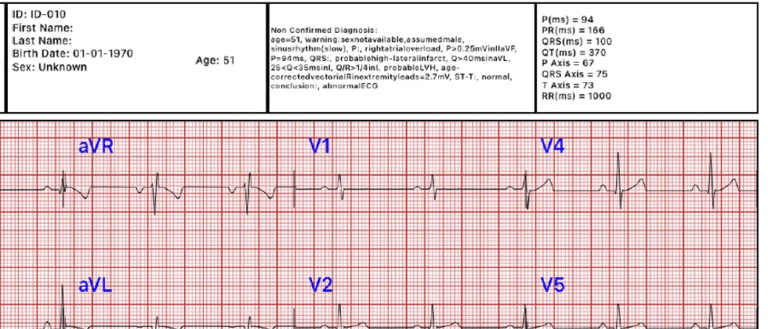 Holter ECG | Ultimate holter ecg monitor - Norav Medical